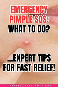 How to Deal with a Big Pimple on Your Face: Expert Tips for Quick ...