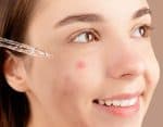 How to Deal with a Big Pimple on Your Face: Expert Tips for Quick ...