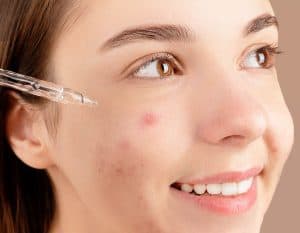 How to Deal with a Big Pimple on Your Face: Expert Tips for Quick ...