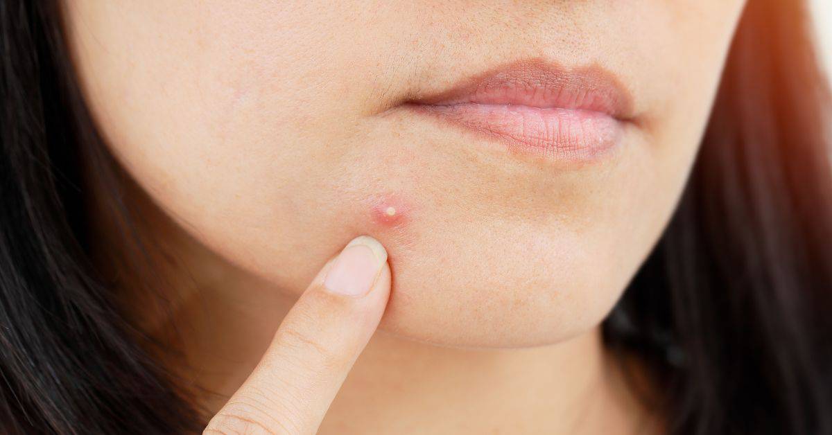 How to Deal with a Big Pimple on Your Face: Expert Tips for Quick ...