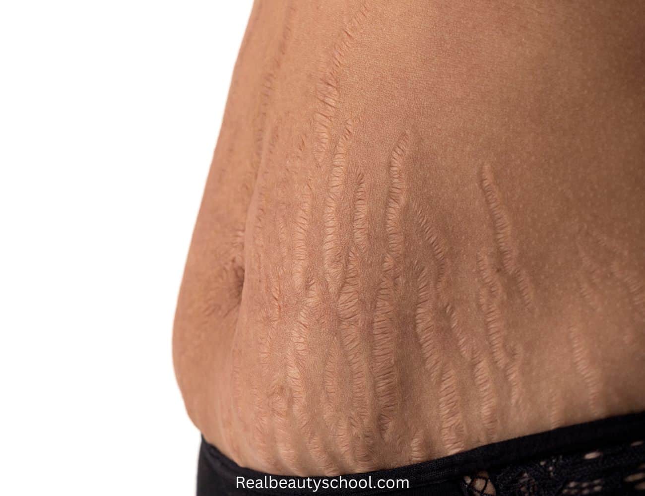 Why You Should Be Using Retinol for the Body (for stretch marks, Rough ...